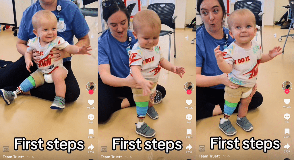 Baby takes first steps with prosthetic leg after severe birth defect in ...